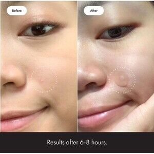 Bath & Body | The Original Mighty Patch Hydrocolloid 36pc Box Blemish Pimples Dermatologist ...